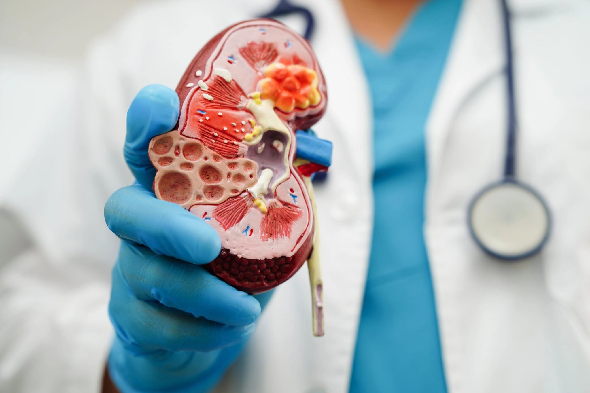 Kidney Stones In Women: Your Body’s Red Flag on Metabolism